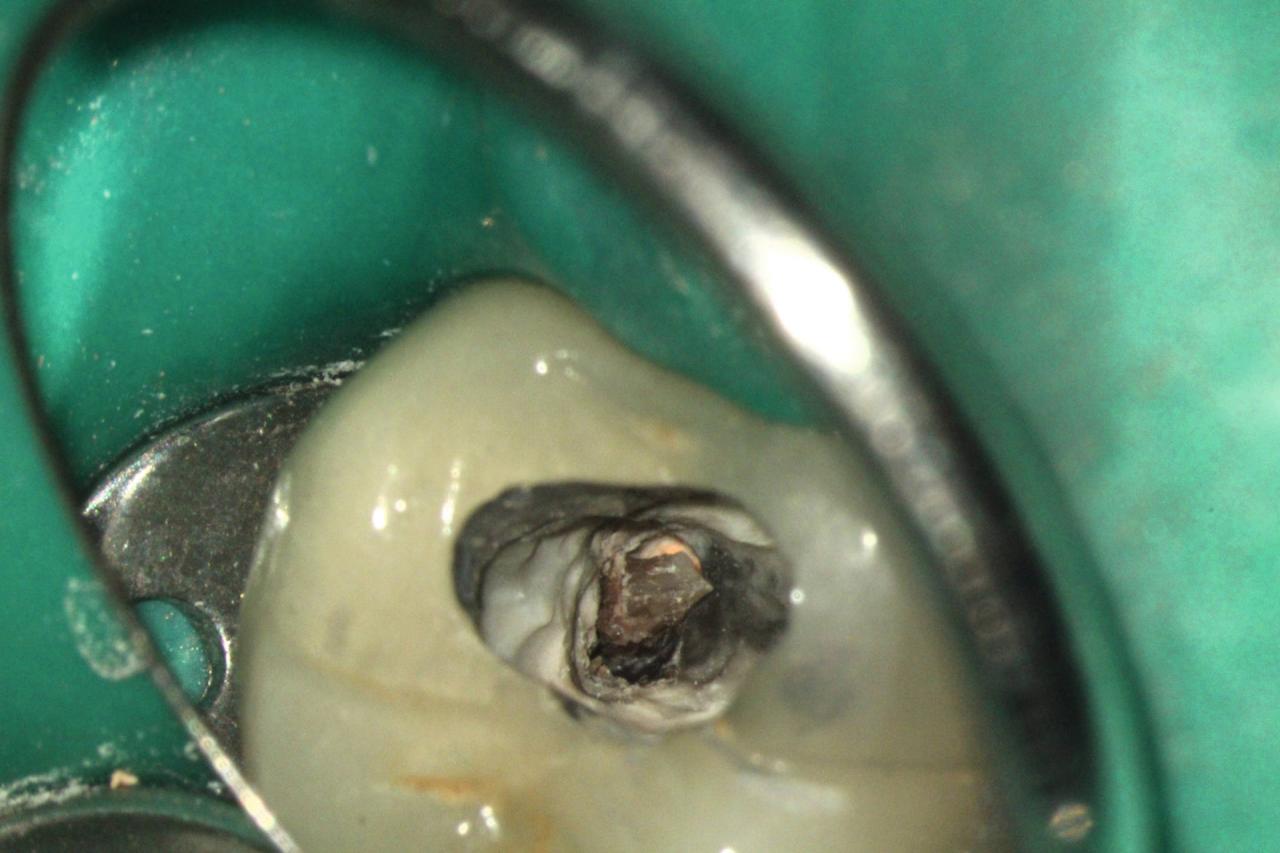 Non-surgical re-treatment