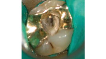 Non-surgical re-treatment