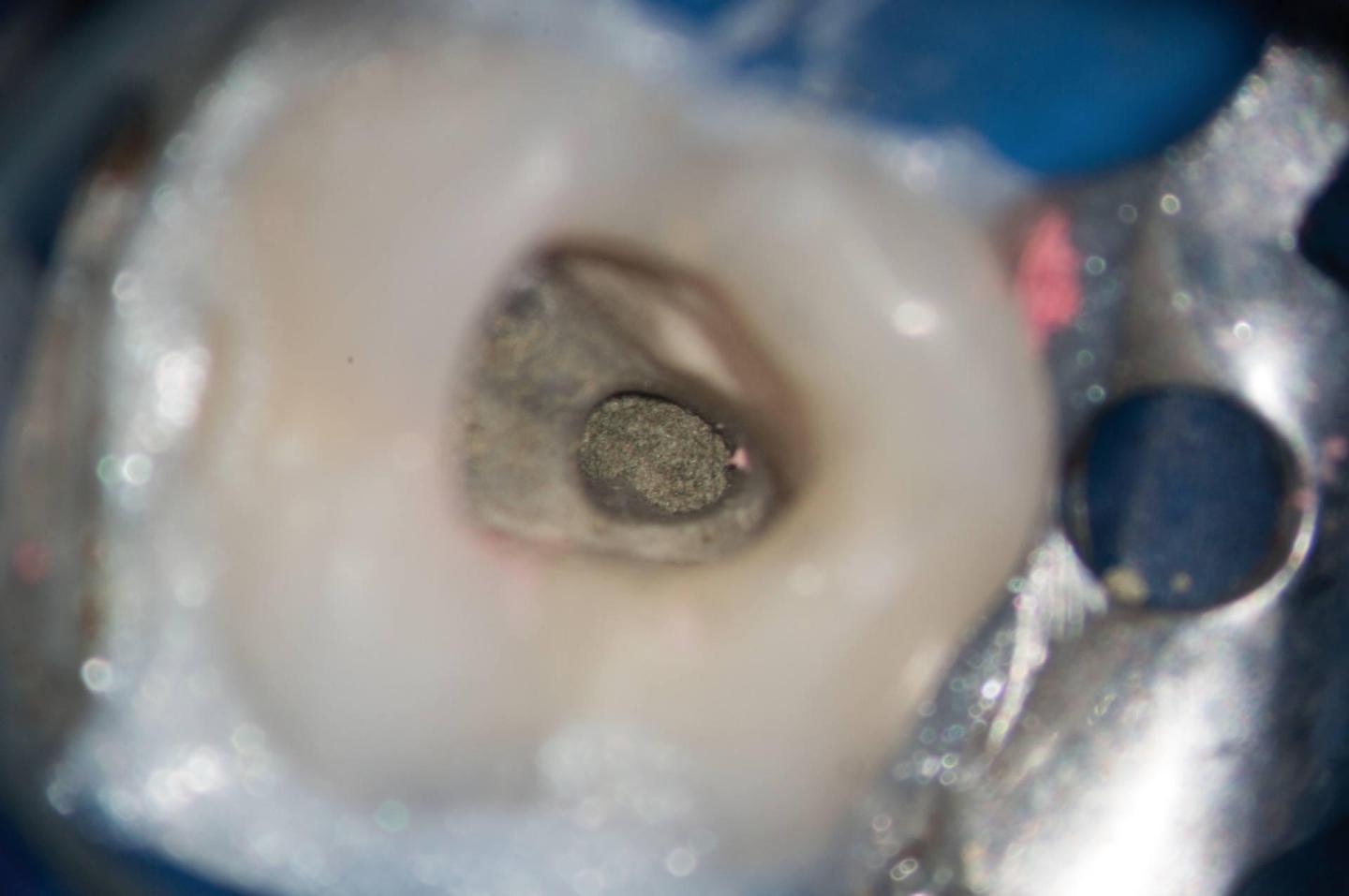 Non-surgical re-treatment