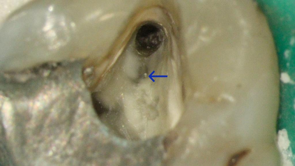 MB2 canals are commonly missed