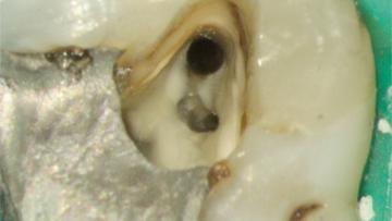 MB2 canals are commonly missed