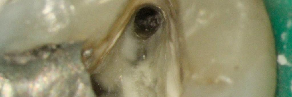 MB2 canals are commonly missed