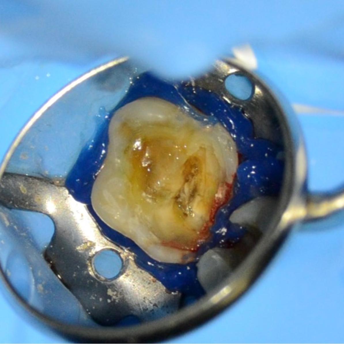 root canal under microscope