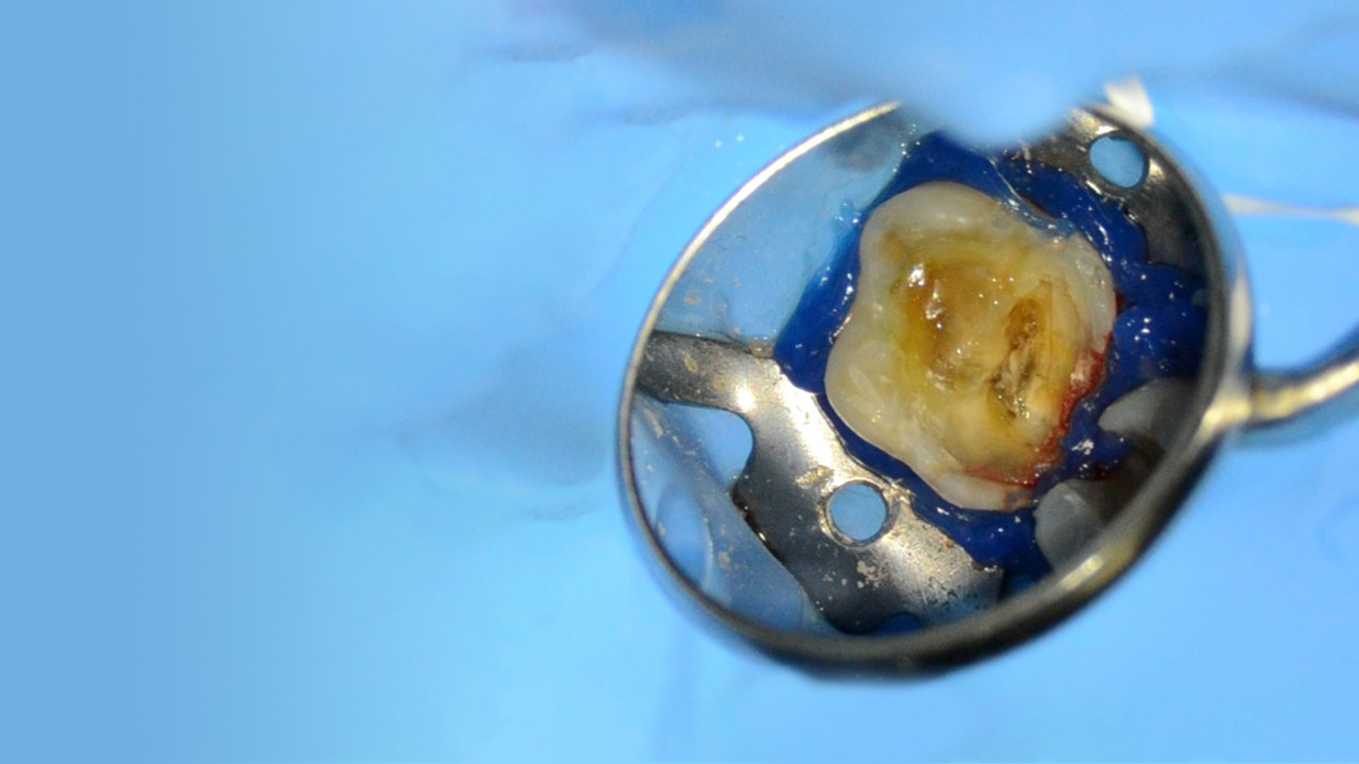 Dealing with calcified chambers