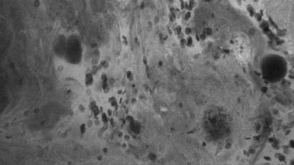 Specialties | Neurosurgery | Brain Tumor Resection