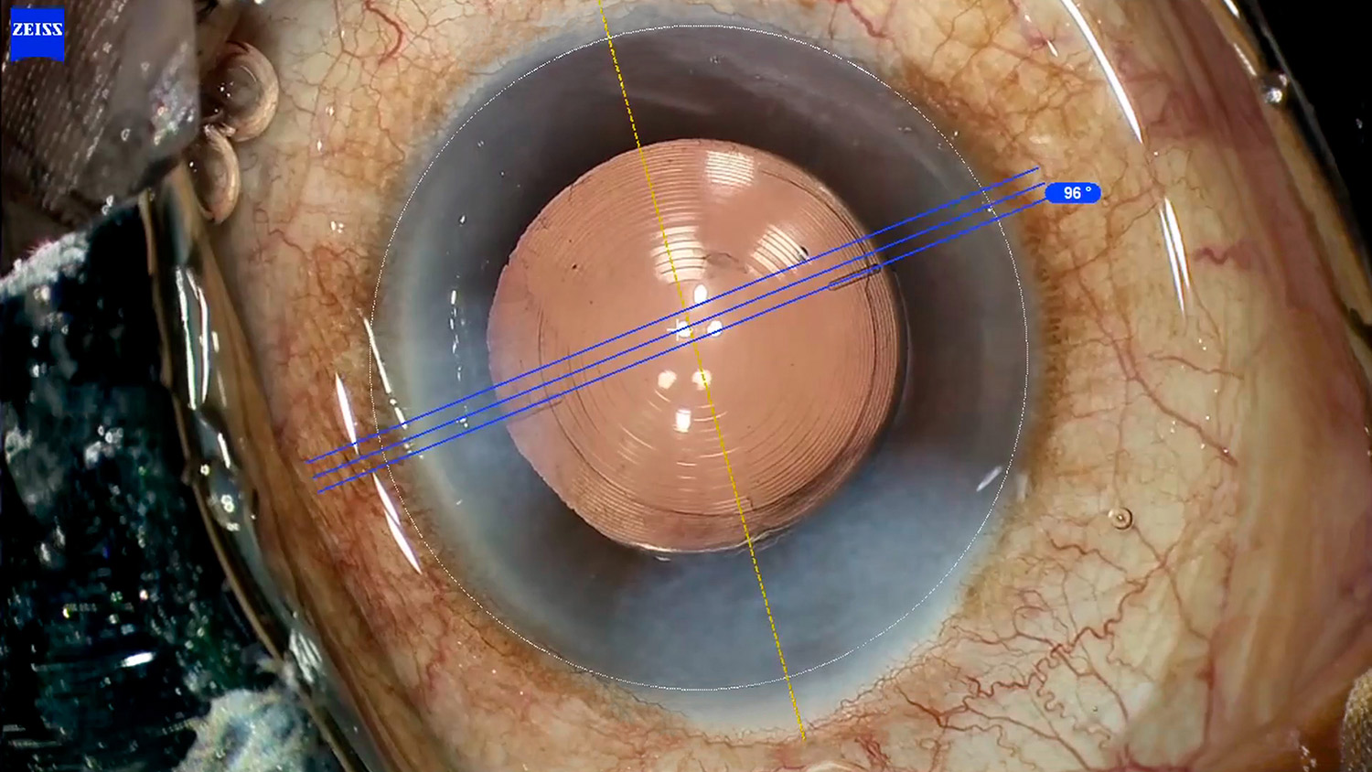 Simple and precise alignment of toric IOLs