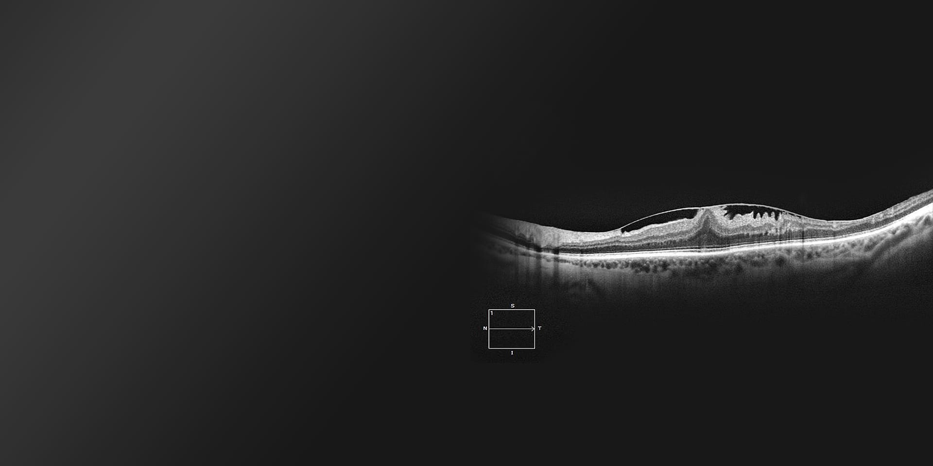 Évaluation des cataractes denses ZEISS