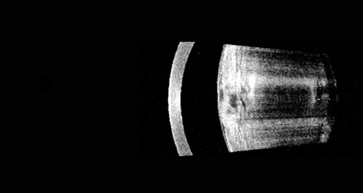 Dense Cataract Zeiss Medical Technology