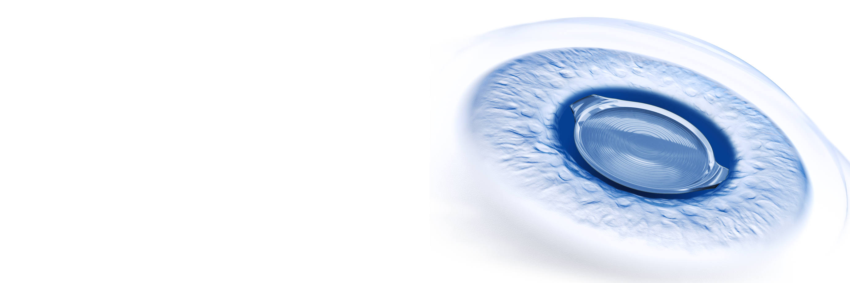 Premium Cataract Workflow | ZEISS Medical Technology