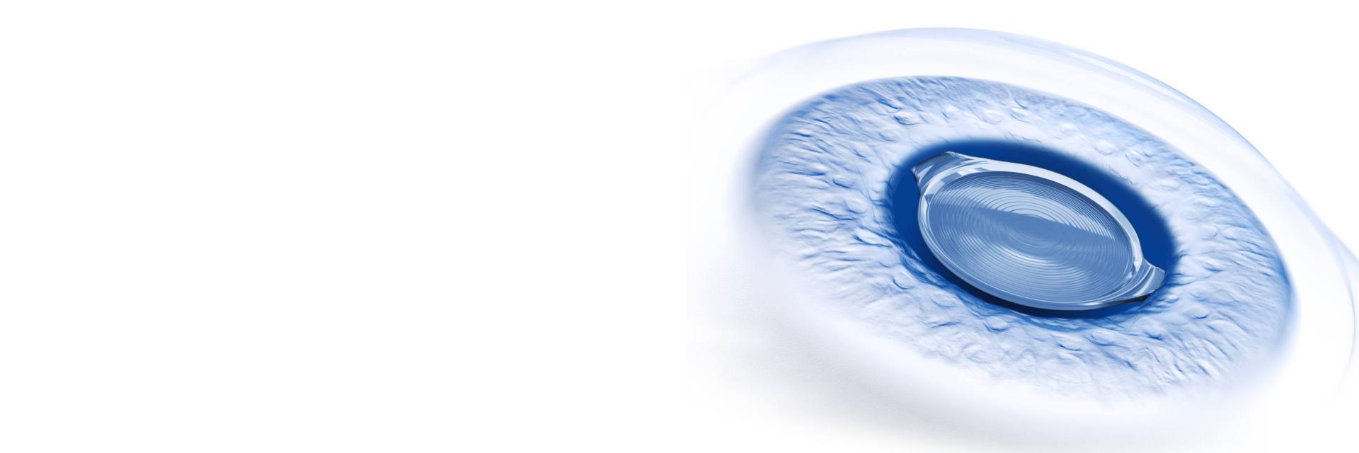Premium Cataract Workflow | ZEISS Medical Technology