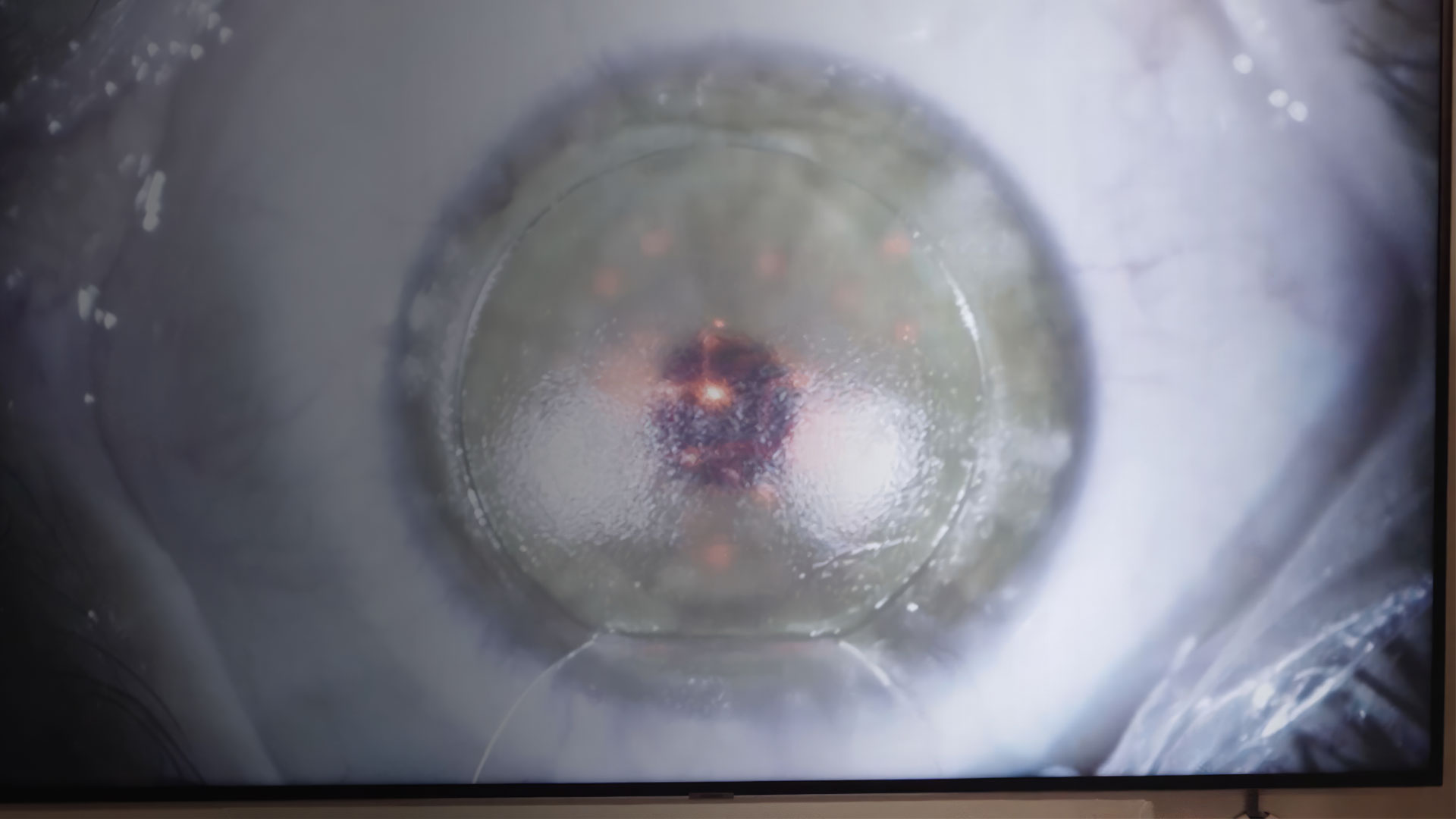 ZEISS Presbyopia Management: Treat