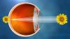 What are Cataracts? - Zeiss