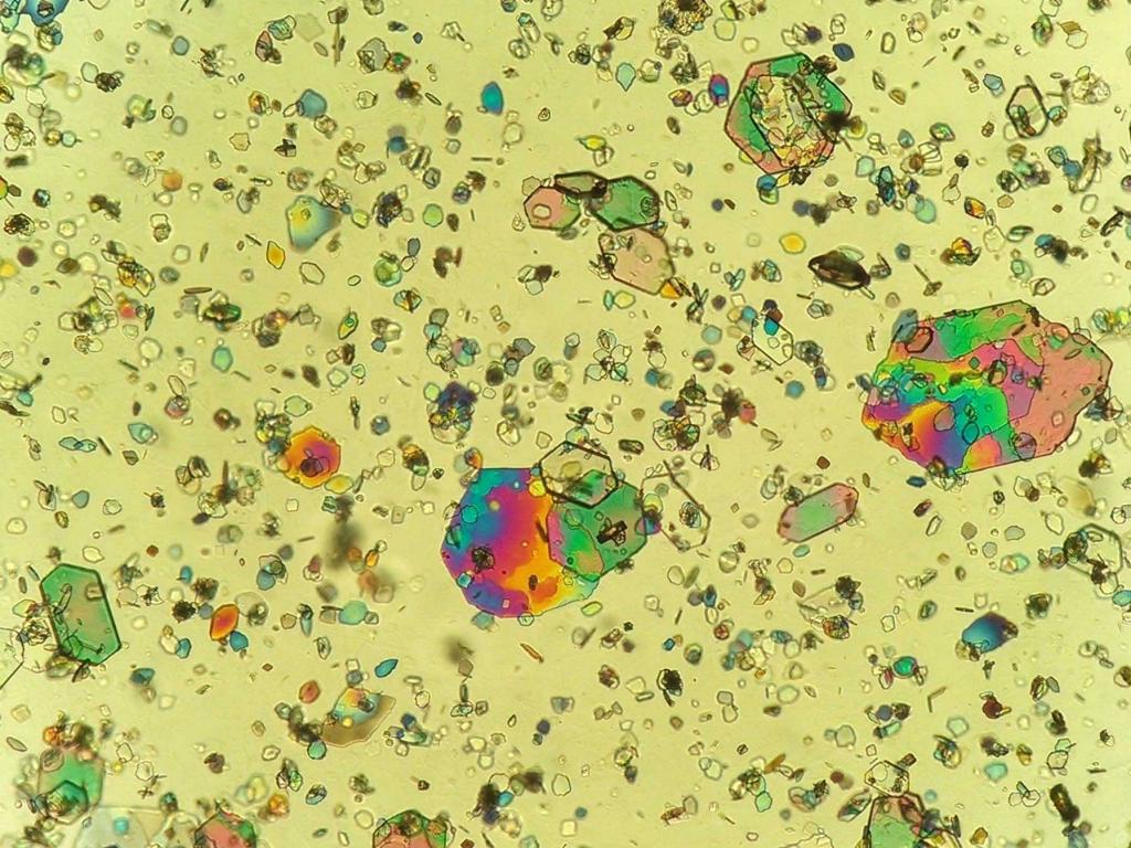 Microscopy in Urinalysis: Observe Urine, Detect Abnormalities