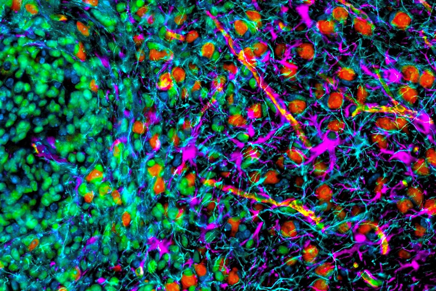 Brain Tumor Microenvironment Spatial Changes Uncovered by High ...