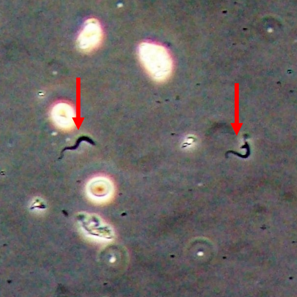 Stain Precipitate In Urine