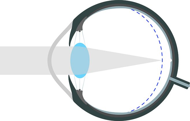 Myopia – More Than a Simple Visual Impairment