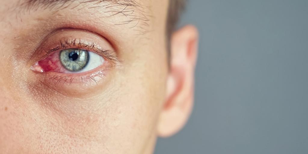 lower eyelid infections in adults
