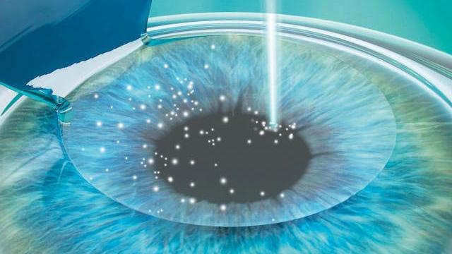 LASIK - Laser Eye Surgery