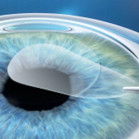 SMILE - Laser Eye Surgery