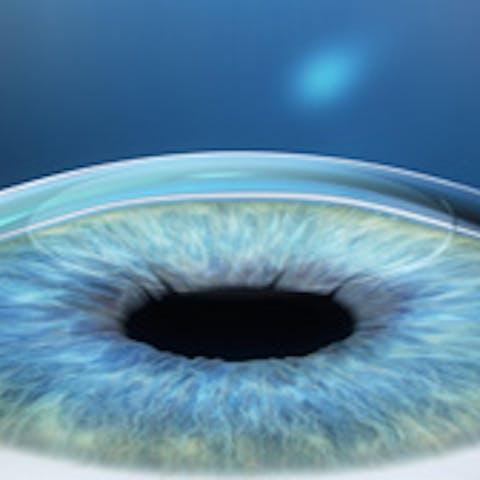 SMILE - Laser Eye Surgery